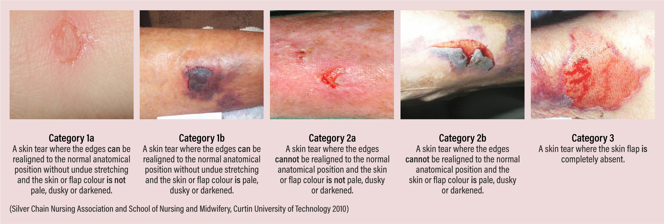 Skin Tear Classification Skin Tear Classification