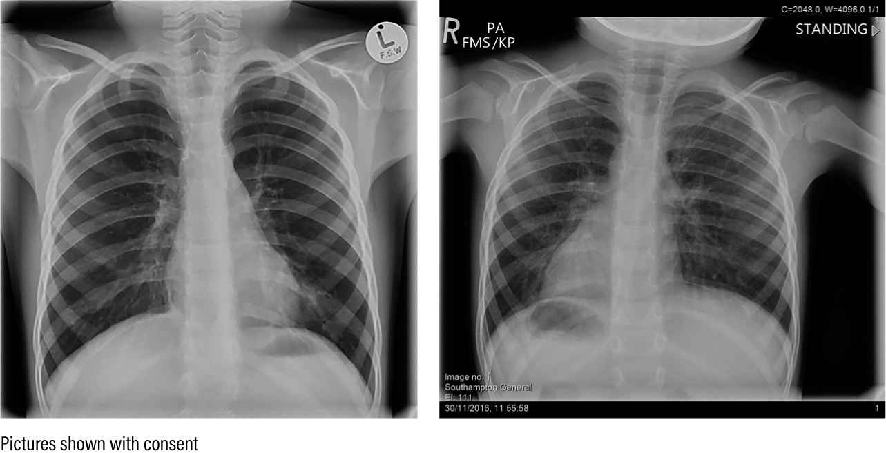Diagnosis and management of children with primary ciliary dyskinesia